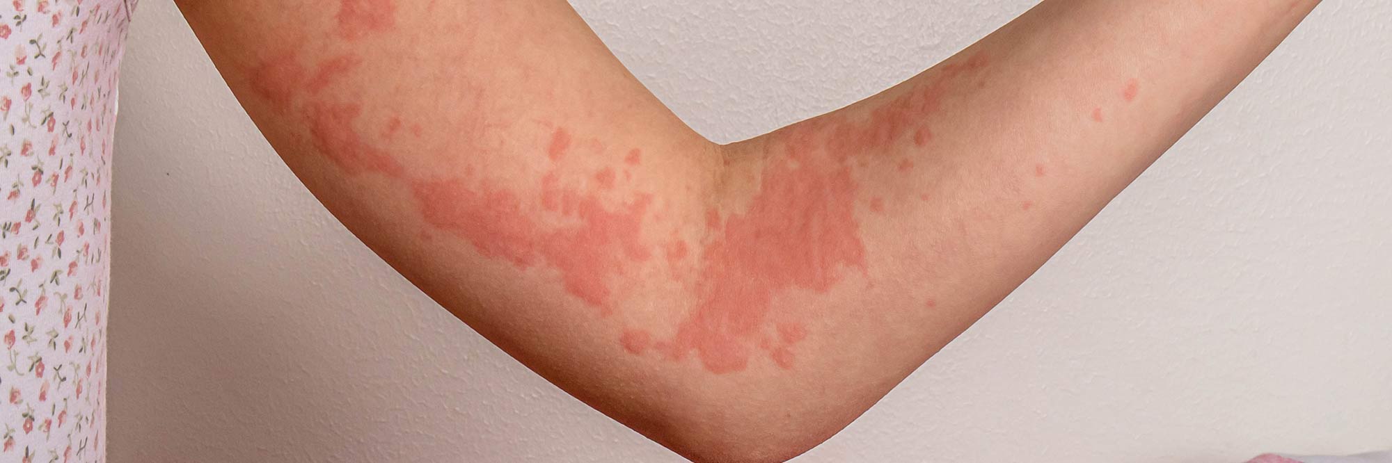 Hives: What they look like, possible causes and treatments - usbom.com